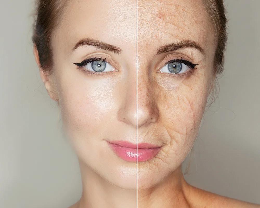 Sculptra / Radiesse Collagen Stimulators Benfleet, Aesthetics In ...