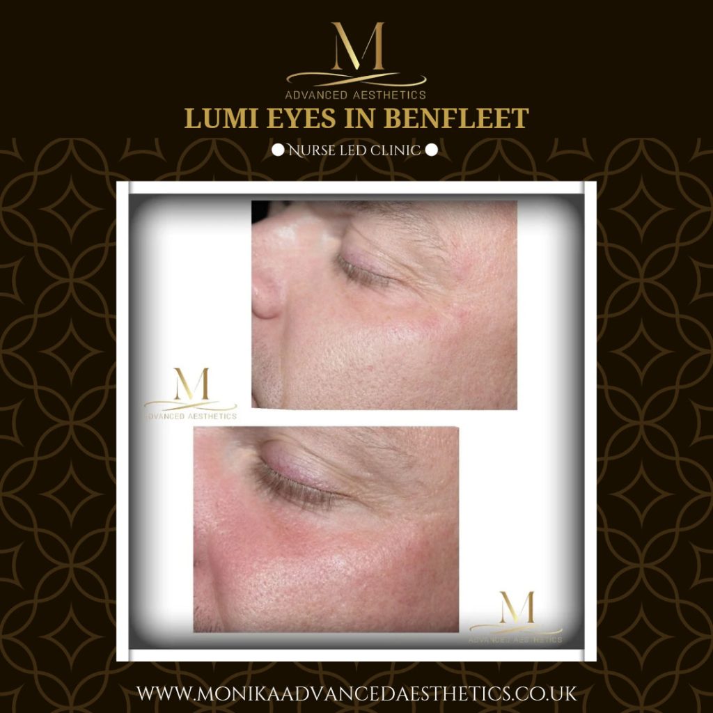Lumi Eyes In Benfleet, Aesthetics In Benfleet, Essex